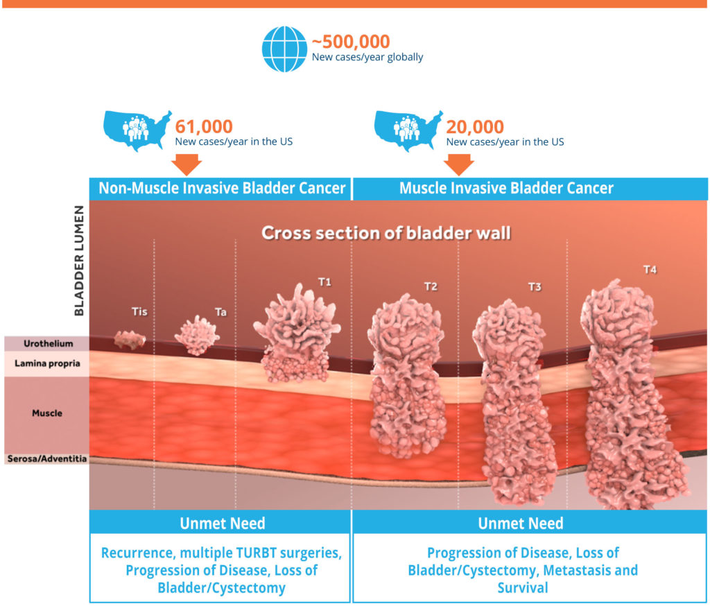 Bladder Cancer Aura Biosciences