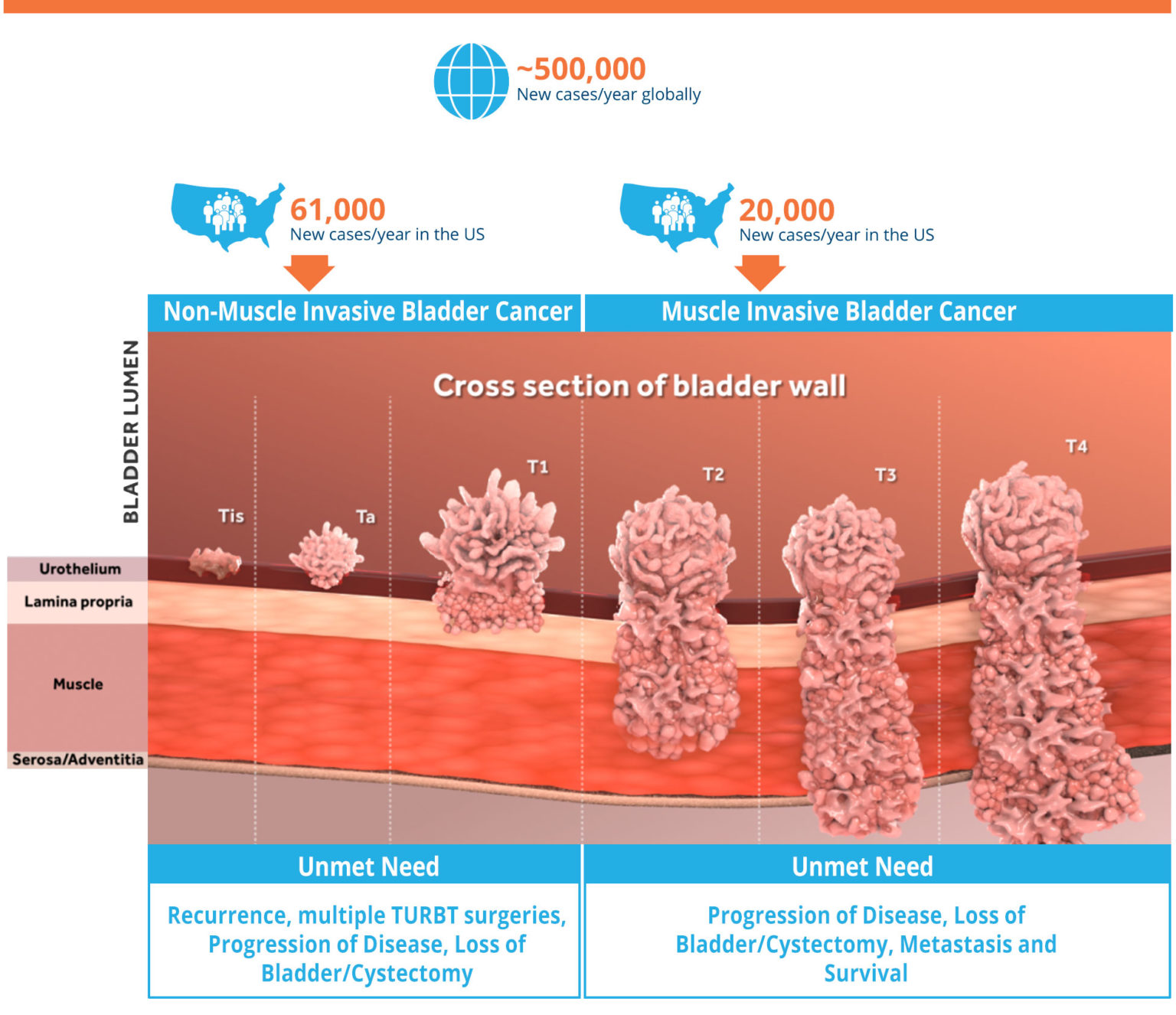 Bladder Cancer - Aura Biosciences